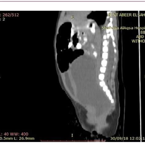 Sagittal View Ct Hydrocolpos Made Pressure On The Urine Bladder