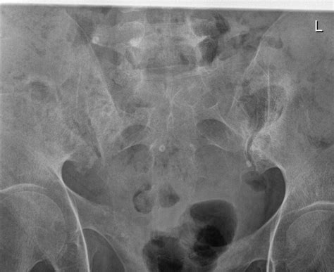 Subchondral Sclerosis Si Joint