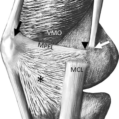 Normal Mr Imaging Anatomy Of The Medial Patellofemoral Ligament Mpfl Download Scientific