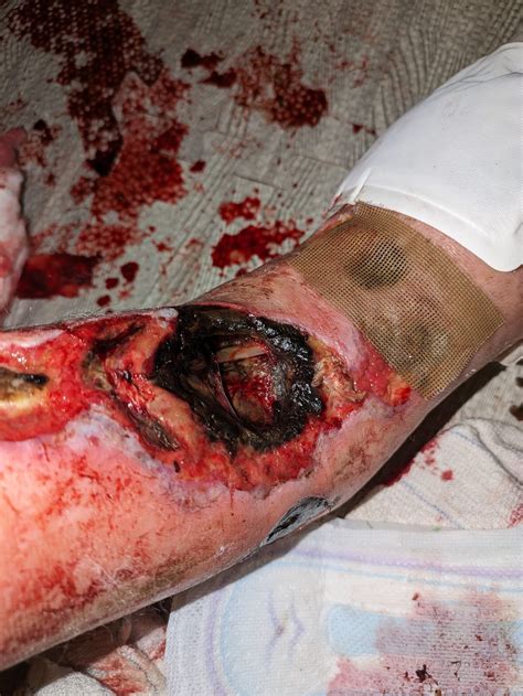 Pyoderma Gangrenosum In My Mothers Leg Pt 3 Tendon Snapped More Info