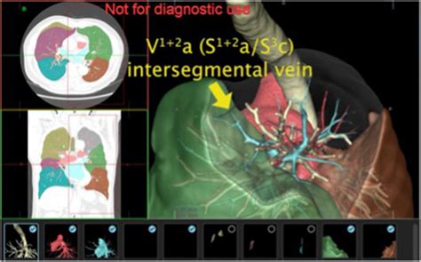 Segmentectomy Oriented Anatomical Model For Enhanced Precision Surgery Of The Left Upper Lobe