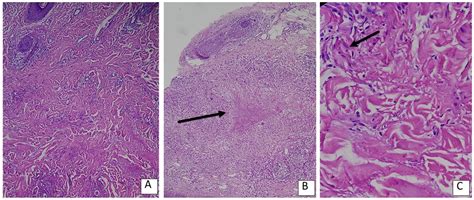 Clinical And Histopathological Characteristics Of Granuloma Annulare