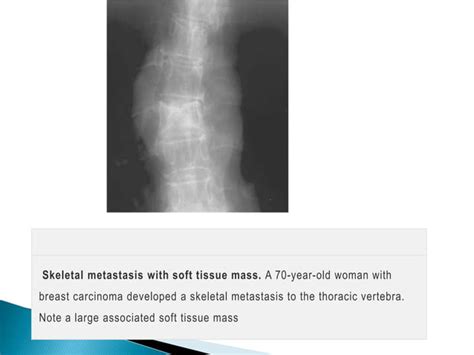Metastatic Bone Disease Pptx