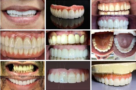Tipos De Prótese Dentarias Materiais De Protese Dentaria Implart