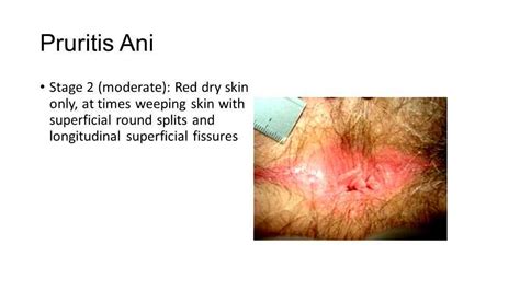 Pruritus Ani