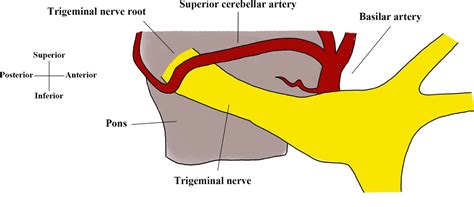 Bilateral Trigeminal Neuralgia Due To Bilaterally Duplicated Superior Cerebellar Arteries Bmj