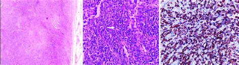 Photomicrograph Showing Effaced Lymph Node Architecture With Extensive Download Scientific