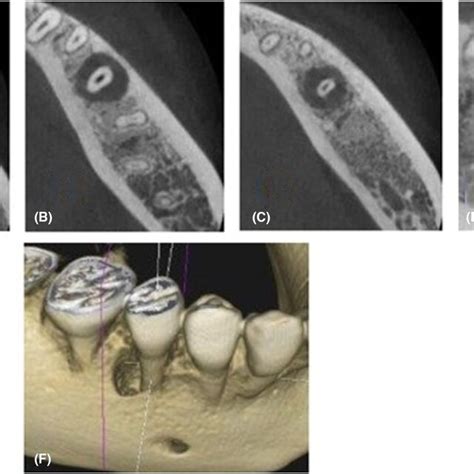 A Pre‐op Intraoral Photograph Of Mandibular Right Second Premolar