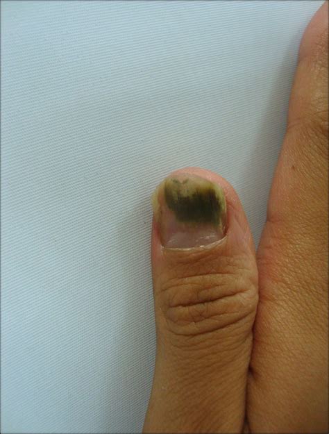 Green Nail Syndrome Treated With The Application Of Tobramycin Eye Drop Pmc