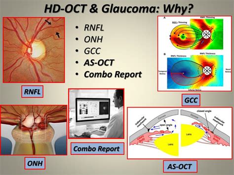 PPT OCT G Laucoma Vantaggi E Limiti PowerPoint Presentation ID 5131535