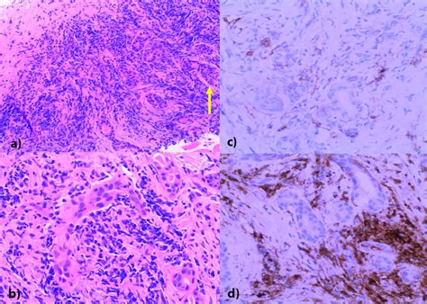 A Low Power 10x Hande Stain Showing Fibrotic Parotid Tissue With