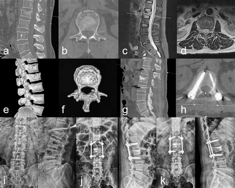 C Arm Oblique Viewassisted Screw Placement Method For Extremely Small