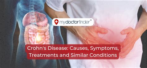 Crohns Disease Causes Symptoms Treatments And Similar Conditions