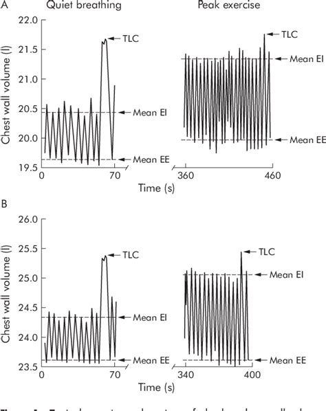 Figure 1 From Chronic Obstructive Pulmonary Disease Patterns Of Dynamic