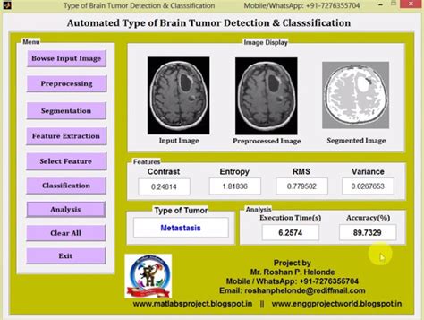 Types Of Brain Tumor Detection Using Matlab Project Source Code IEEE Based Project Matlab