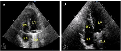 Post Operative Findings In A Patient With Infective Endocarditis And Download Scientific