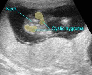 Cystic Hygroma Department Of Obstetrics And Gynecology Faculty Of