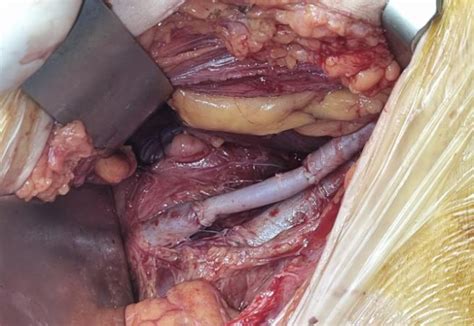External Iliac Ligation Download Scientific Diagram