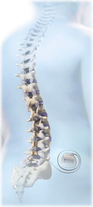 The Implanted Neurostimulator Hungry For More