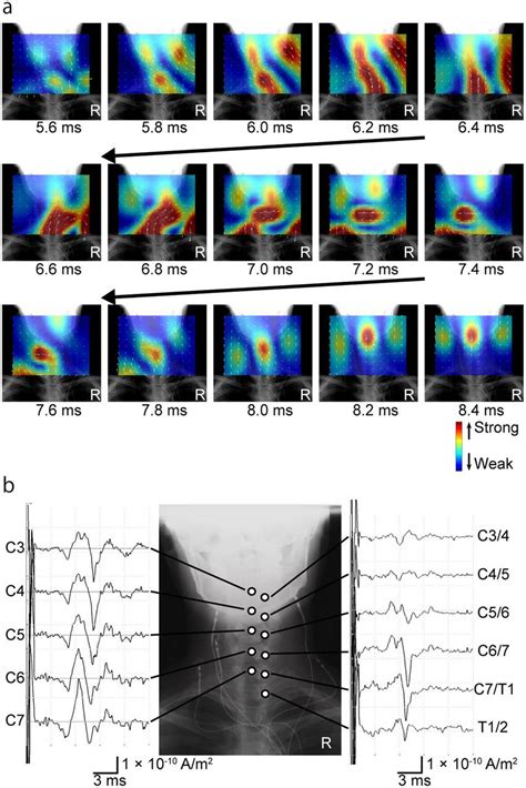 Reconstructed Currents After Stimulation Of The Right Median Nerve At
