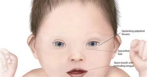 Is Reducing Down Syndrome Births A Form Of Eugenics Psychology Today