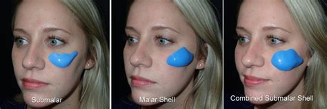 Cheek Implants Artofit