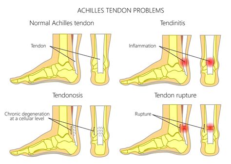 How To Wrap Foot For Extensor Tendonitis At Lorraine Kim Blog