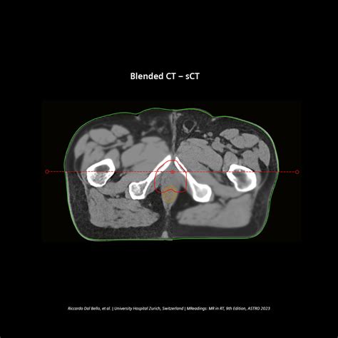 Dose Calculation On Synthetic Ct Siemens Healthineers