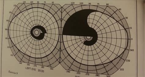 Overview Of Visual Field Analysis Flashcards Quizlet