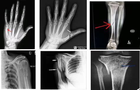 Frontiers Diagnosis And Detection Of Bone Fracture In Radiographic