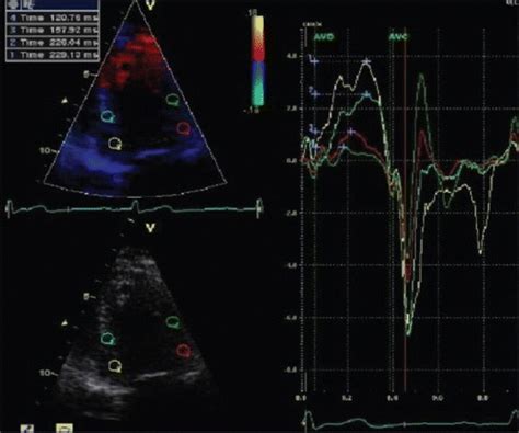 Left Intraventricular Systolic Asynchrony Left Are The Apical