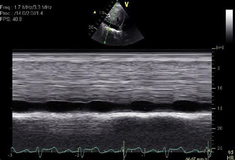 M Mode Imaging Through The Ivc Demonstrating Systolic Dilation Of The