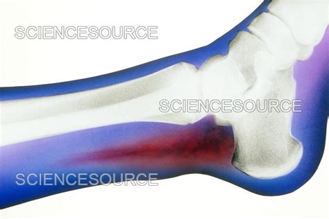 Necrotizing Fasciitis Stock Image Science Source Images