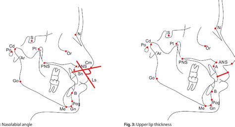 Figure 3 From Relationship Of Nasolabial Angle With Maxillary Incisor Proclination And Upper Lip