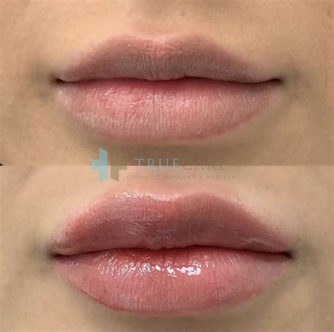 Lip Injections For Fuller Lips Lip Fillers Lip Injections Face