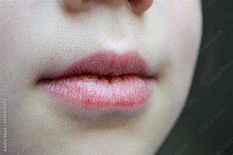 Lips Bleeding Causes At Madeline Mair Blog