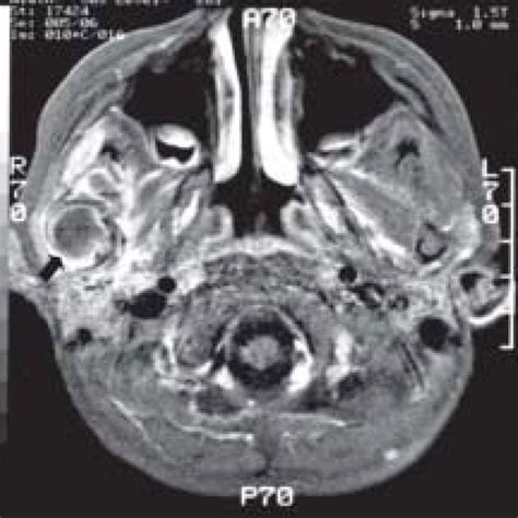 Mri Scan Showing Osteolytic Soft Tissue Mass On The Right Mandibular Download Scientific