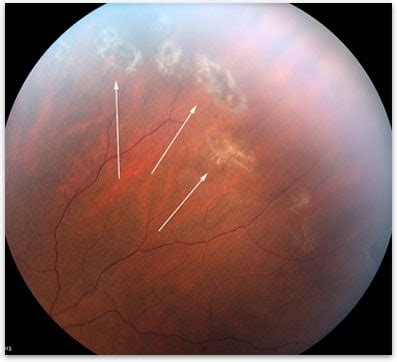Lattice Degeneration Symptoms And Treatment Clinique Visionpros