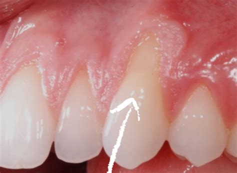 Cd5 Mucogingival Defects And Periodontal Plastic Surgeries Flashcards