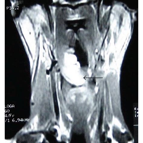 A T2 Weighted Mri Sagittal Image Showing The Tonsillar Polyp With The