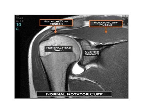Shoulder Impingement Syndrome PPTX