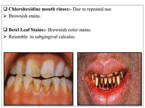 Diffrential Diagnosis Of Common Teeth Complaints Pptx