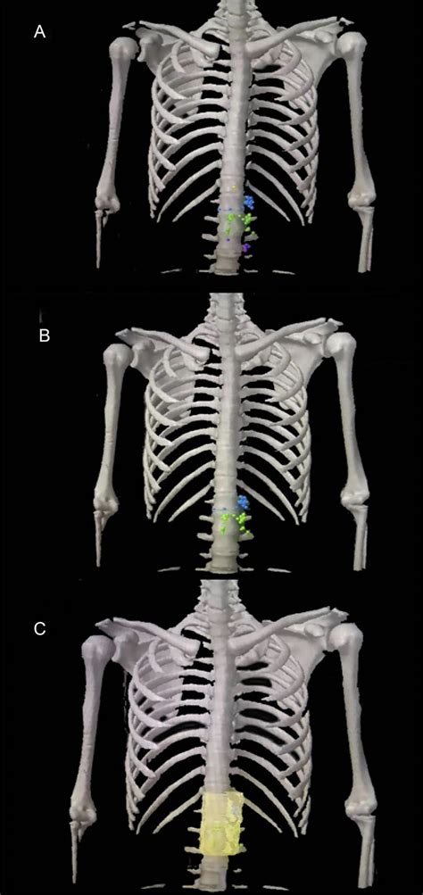 The Para Aortic Ctv Coverage In The Validation Cohort A Paln Map In