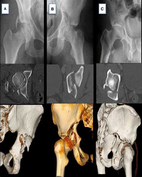 Fracture Classification The Three Most Treated Acetabular Fractures In Download Scientific