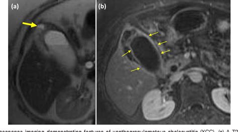 Xanthogranulomatous Cholecystitis Semantic Scholar