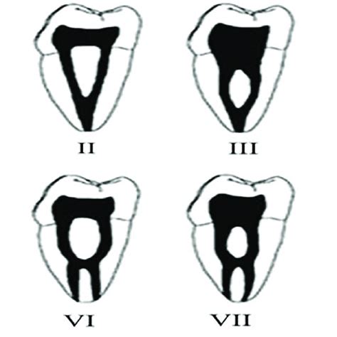 Vertucci Classification Of Root Canal Configuration Download