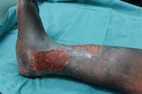 1 En La Categoría Ceap Varicose Veins De Fotos E Imágenes De Stock