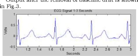 figure 6 from ecg real time feature extraction using matlab semantic