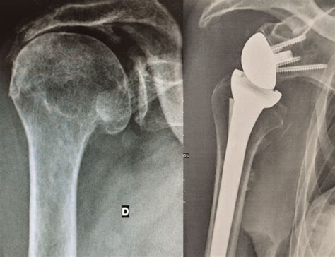 Artroza Umarului Cauze Simptome Tratament Ortopedicum