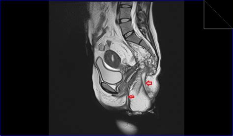 Fistula In Ano Mri Anatomy